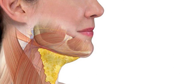 Você já pensou em fazer uma lipo na papada? · Clube da Alice